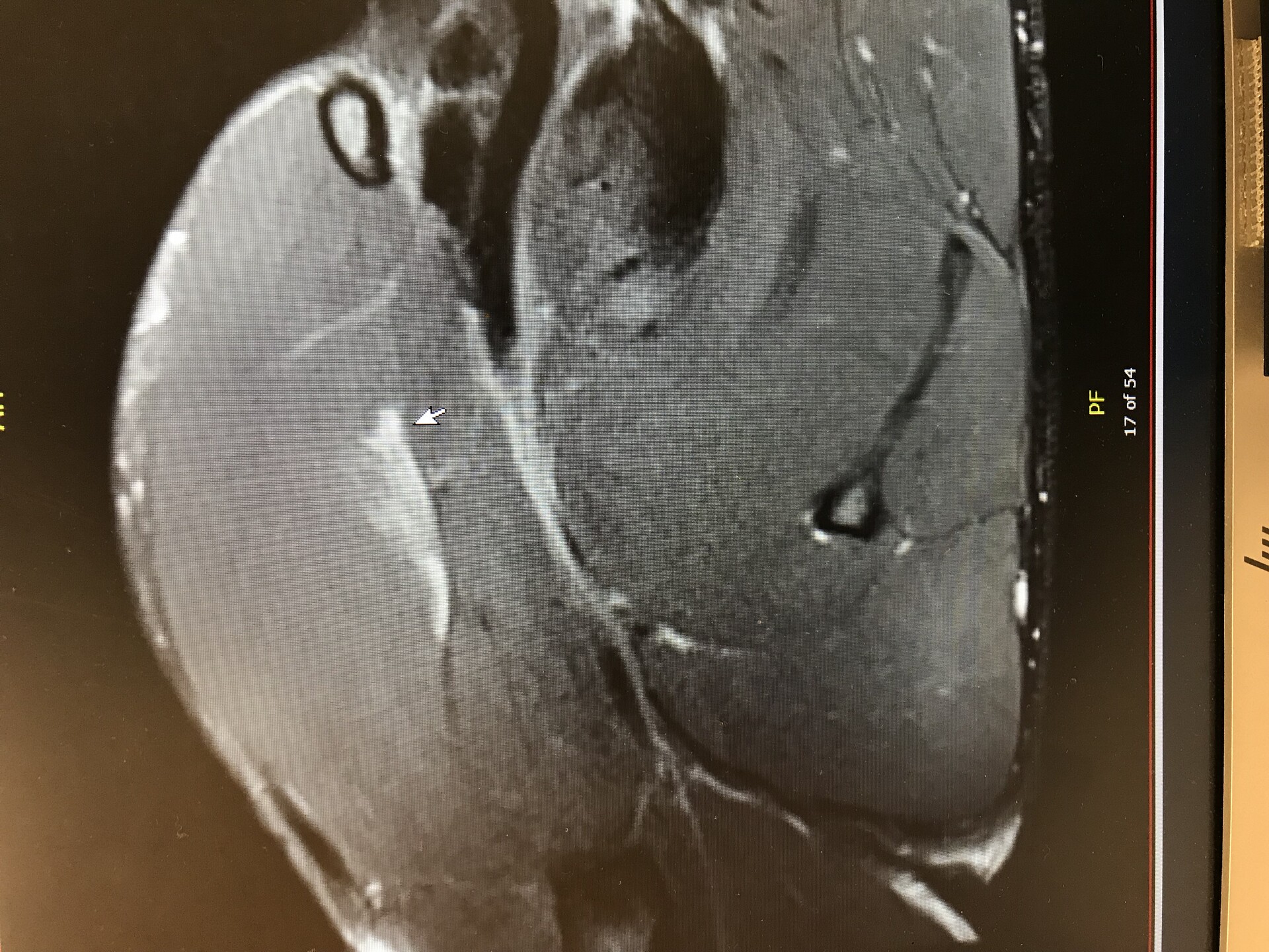 Picture: Pec tear MRI pics